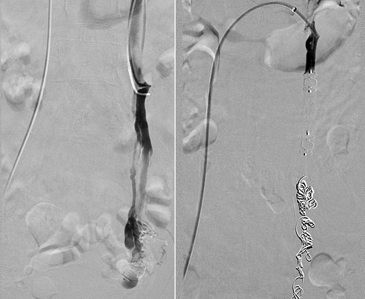 Pelvic Vascular Congestion Syndrome